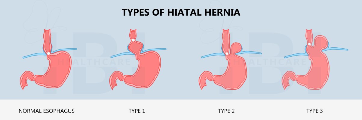 What Size Hiatal Hernia Needs Surgery?
